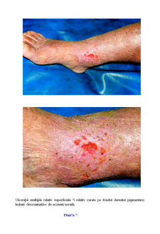 Îngrijirea Pacienților cu Ulcer Varicos | Licență [DOC]