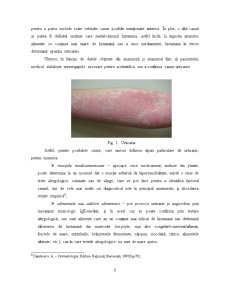 Îngrijirea Pacientului cu Dermatoze Alergice | Licență [DOC]